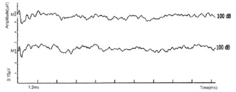 Bera Hearing Test | Bera Test For Hearing | Bera Test For Adults | Bera ...