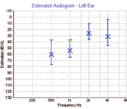 ASSR Hearing Test | Auditory Steady-State Response (ASSR) - Asha Speech