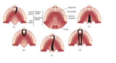 Specialized Cleft Lip and Cleft Palate Treatment at Asha Clinic
